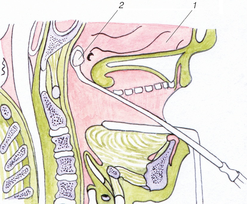 adenoidai - Visuotinė lietuvių enciklopedija